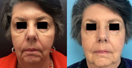 Bellafill Washington DC | Bellafill Filler Chevy Chase